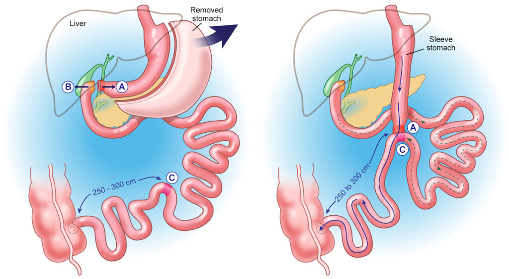 Duodenal Switch Surgery All About Duodenal Switch Procedure